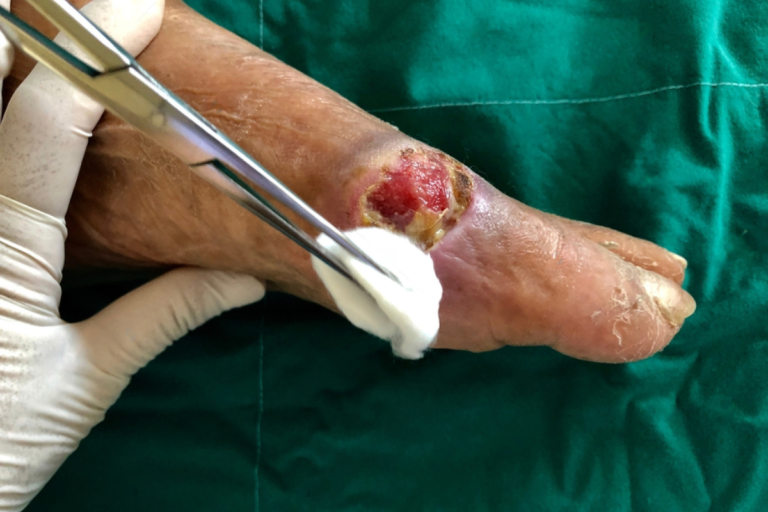 Preventing Amputation Through Strategic Orthopedic Treatment for ...