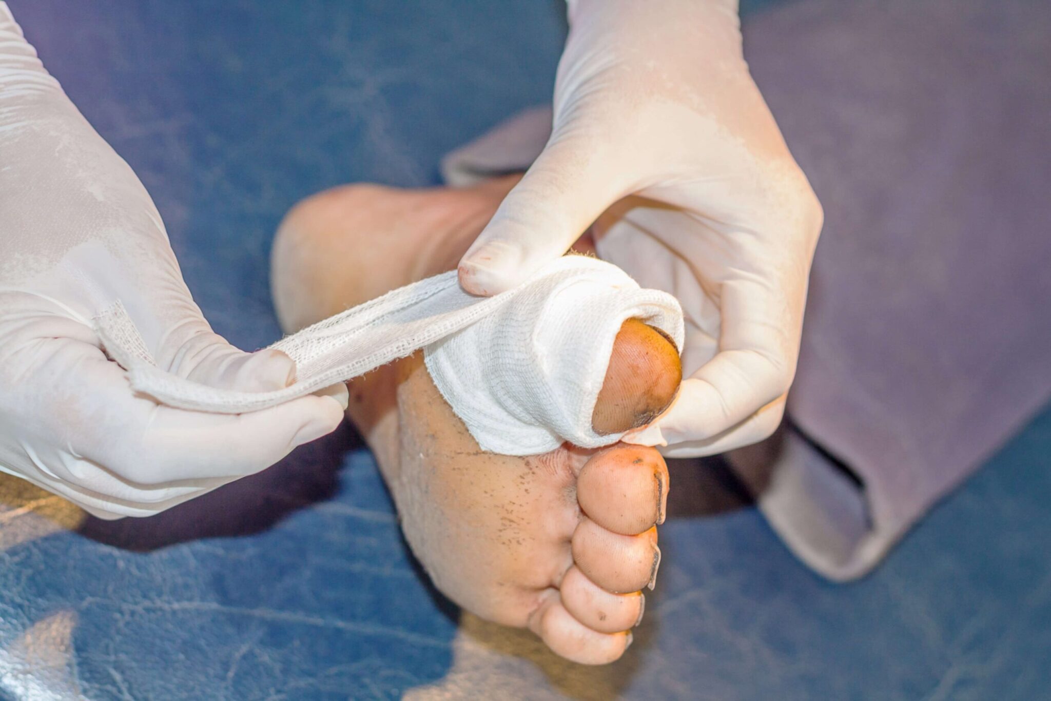 Best Treatments for Sugat sa Paa ng Diabetic Patients in the ...